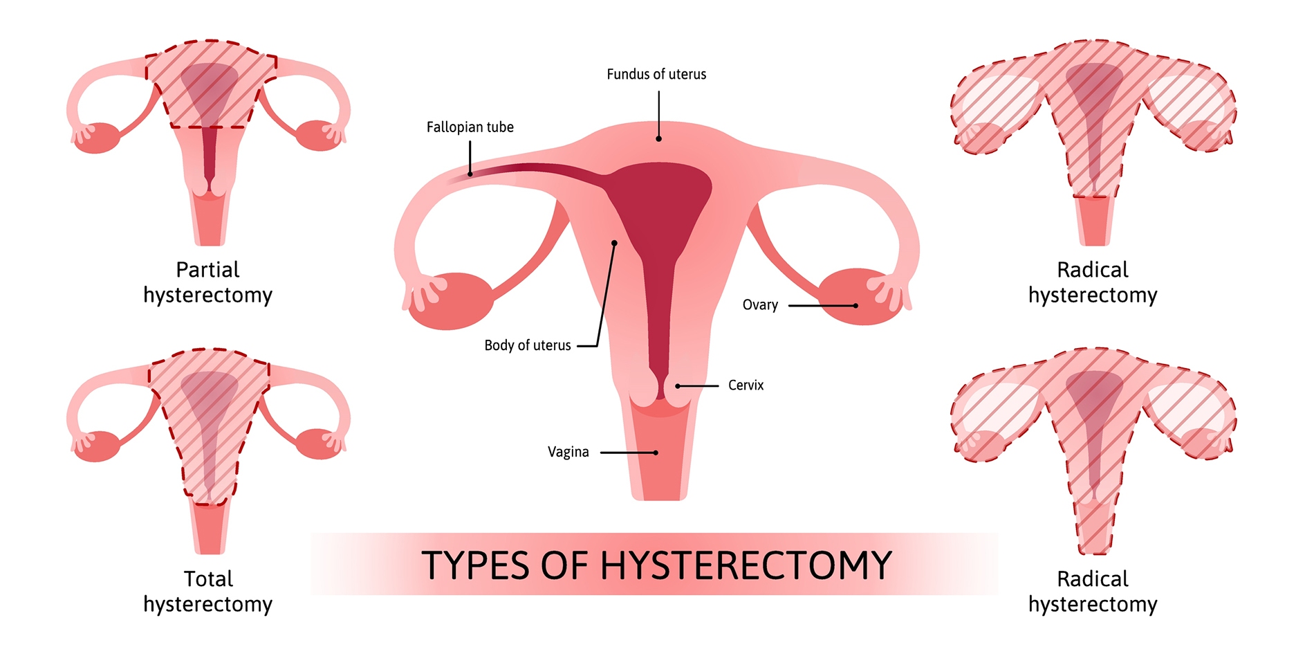 VNOTES The Non Invasive Hysterectomy Procedure VNOTES vnotes-the-non-invasive-hysterectomy-procedure-vnotes